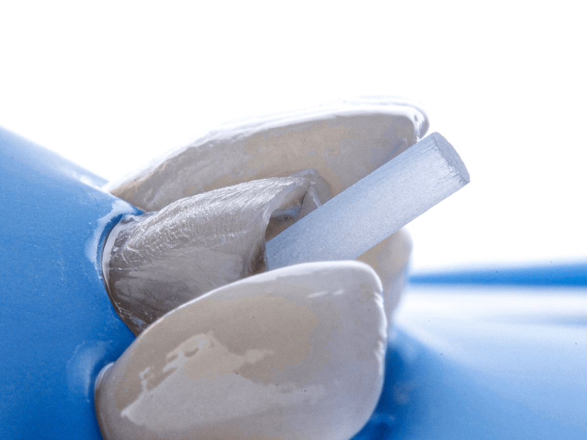 ¿Por qué elegir postes de fibra de vidrio para rehabilitación oral de ...